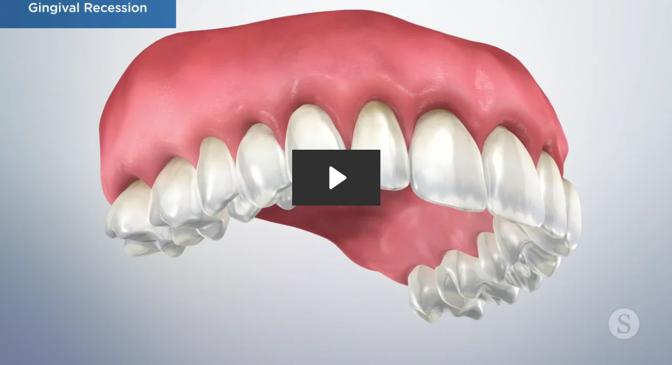 Periodontal Disease Videos | Gum Disease Movies | Gingivitis